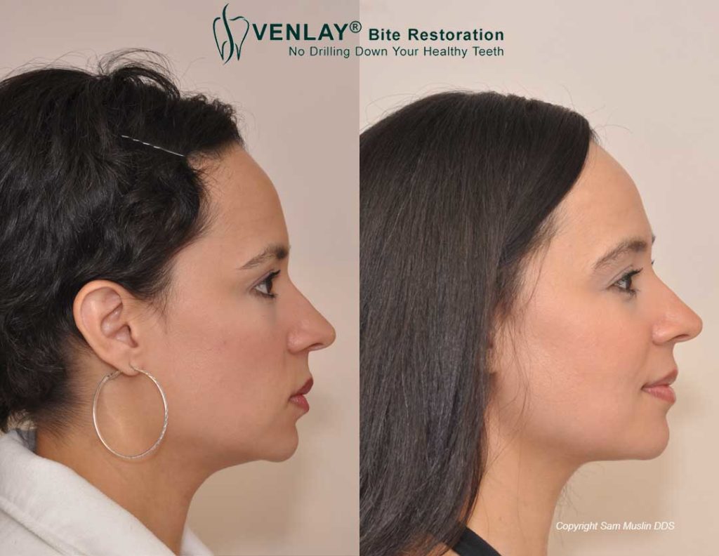 Facial Profile Optimization - Sam Muslin DDS